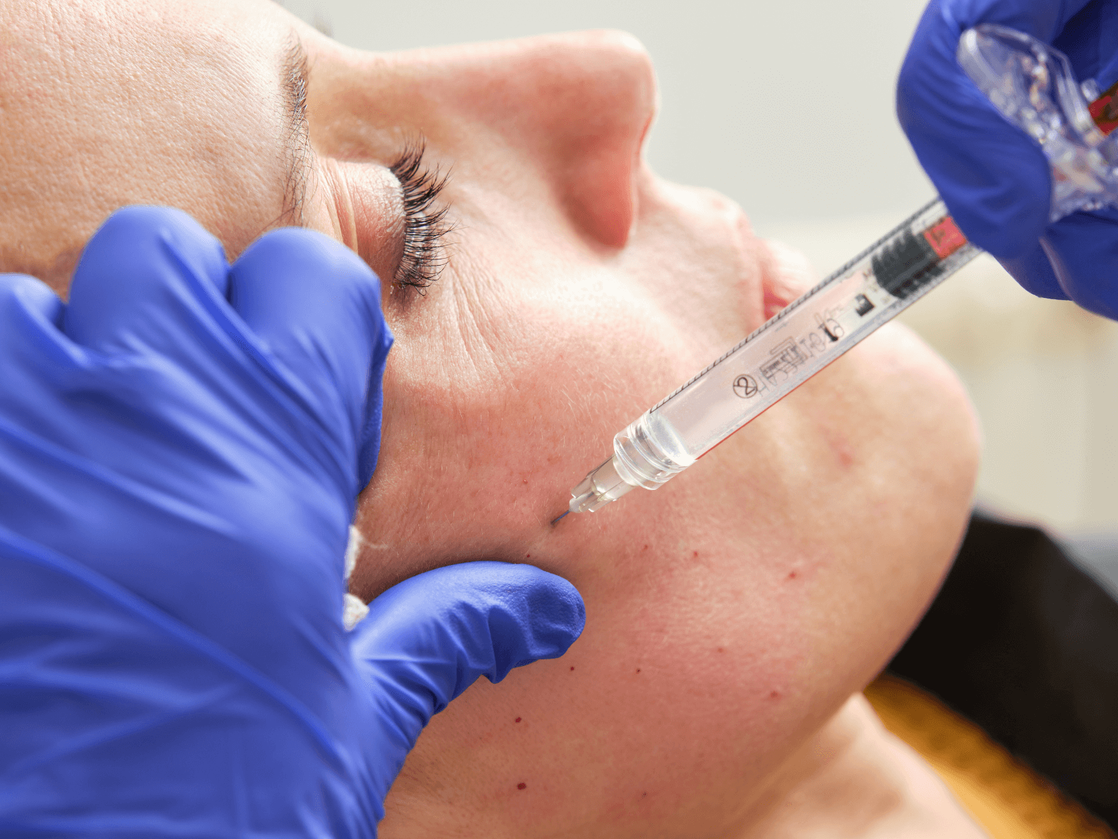 Дермални Филъри - Дентална клиника Бушкалова